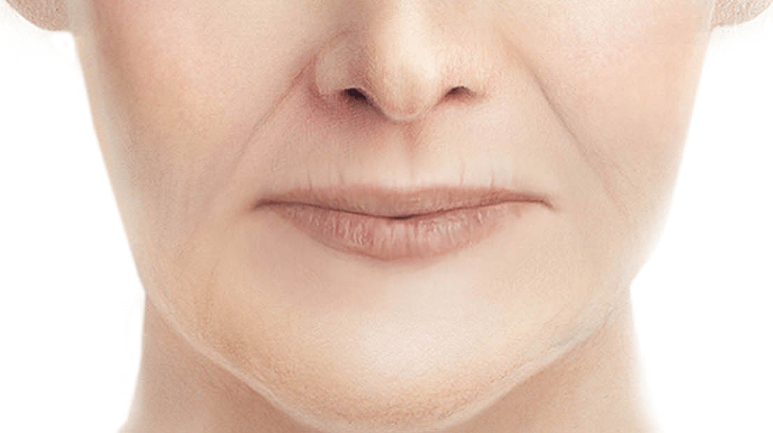 Do You Need a Facelift? | Asheville Aesthethic Plastic Surgery