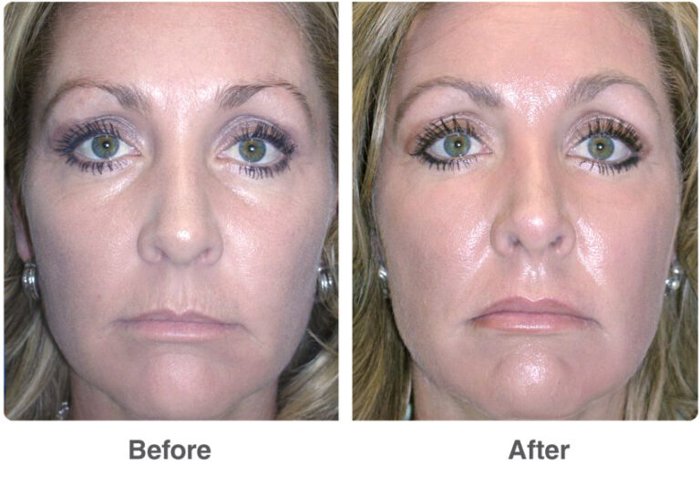 DOT Laser Therapy | Draper Plastic Surgery - Asheville Aesthetics